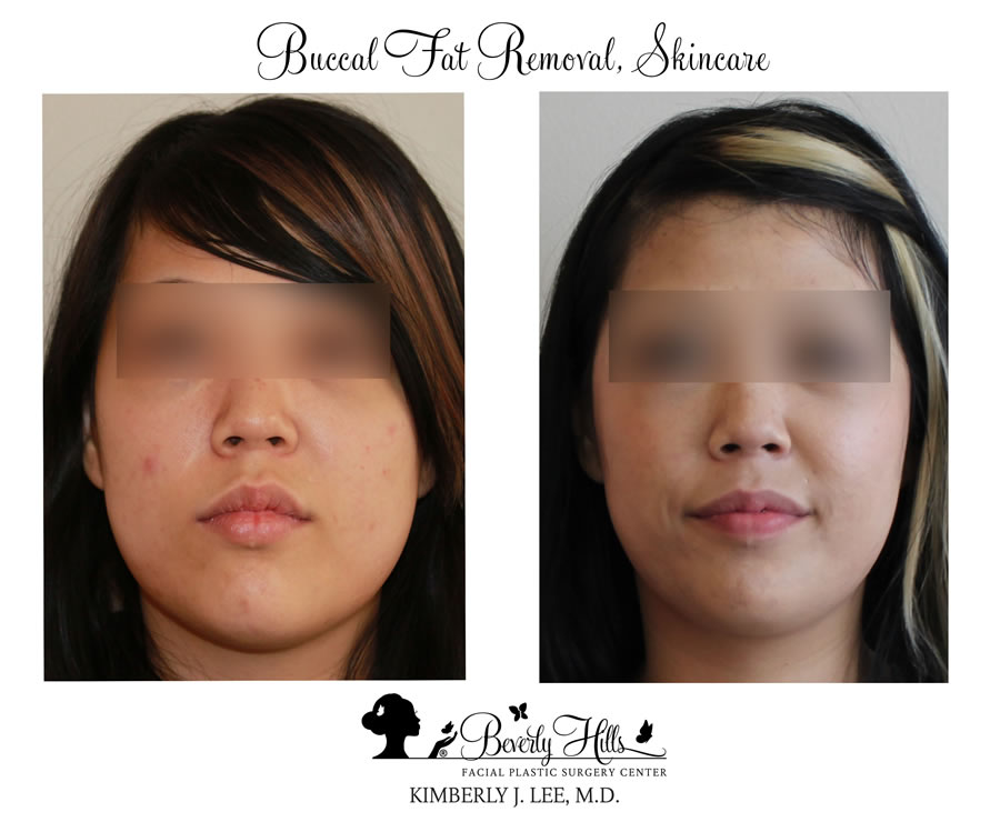 Buccal Fat Removal Before & After Photos | Dr. Kimberly Lee