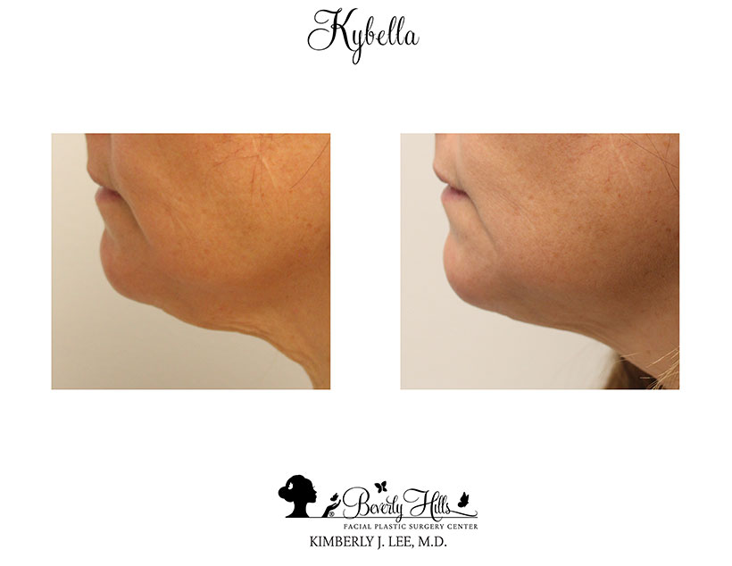 Kybella Before & After Photos | Dr. Kimberly Lee