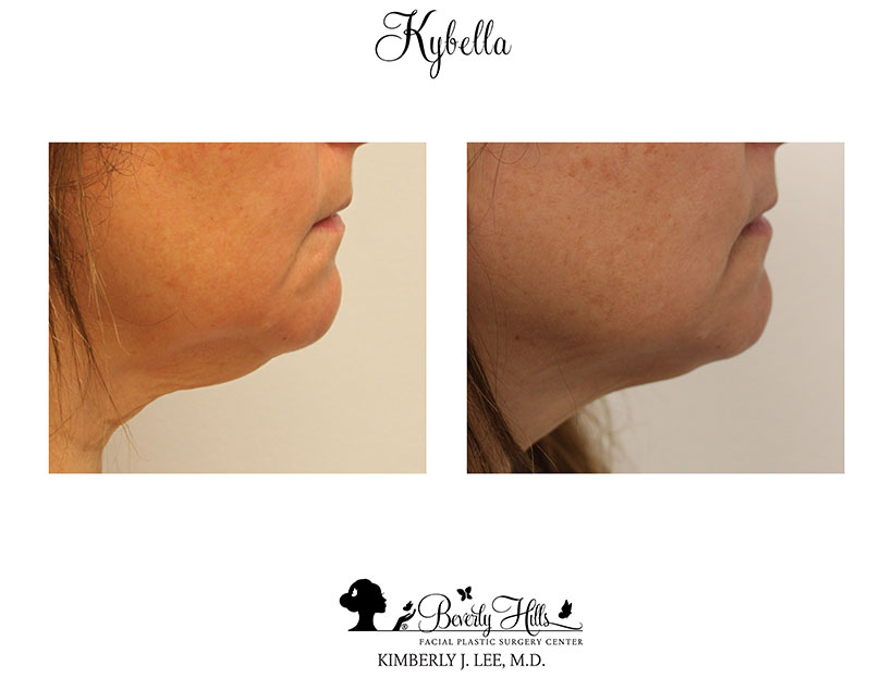 Kybella Before & After Photos | Dr. Kimberly Lee