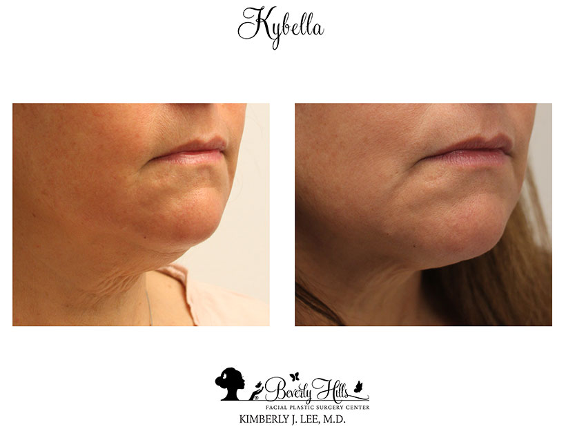 Kybella Before & After Photos | Dr. Kimberly Lee