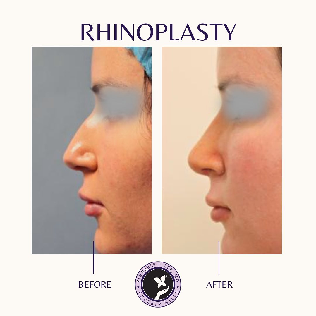 Rhinoplasty Before And After