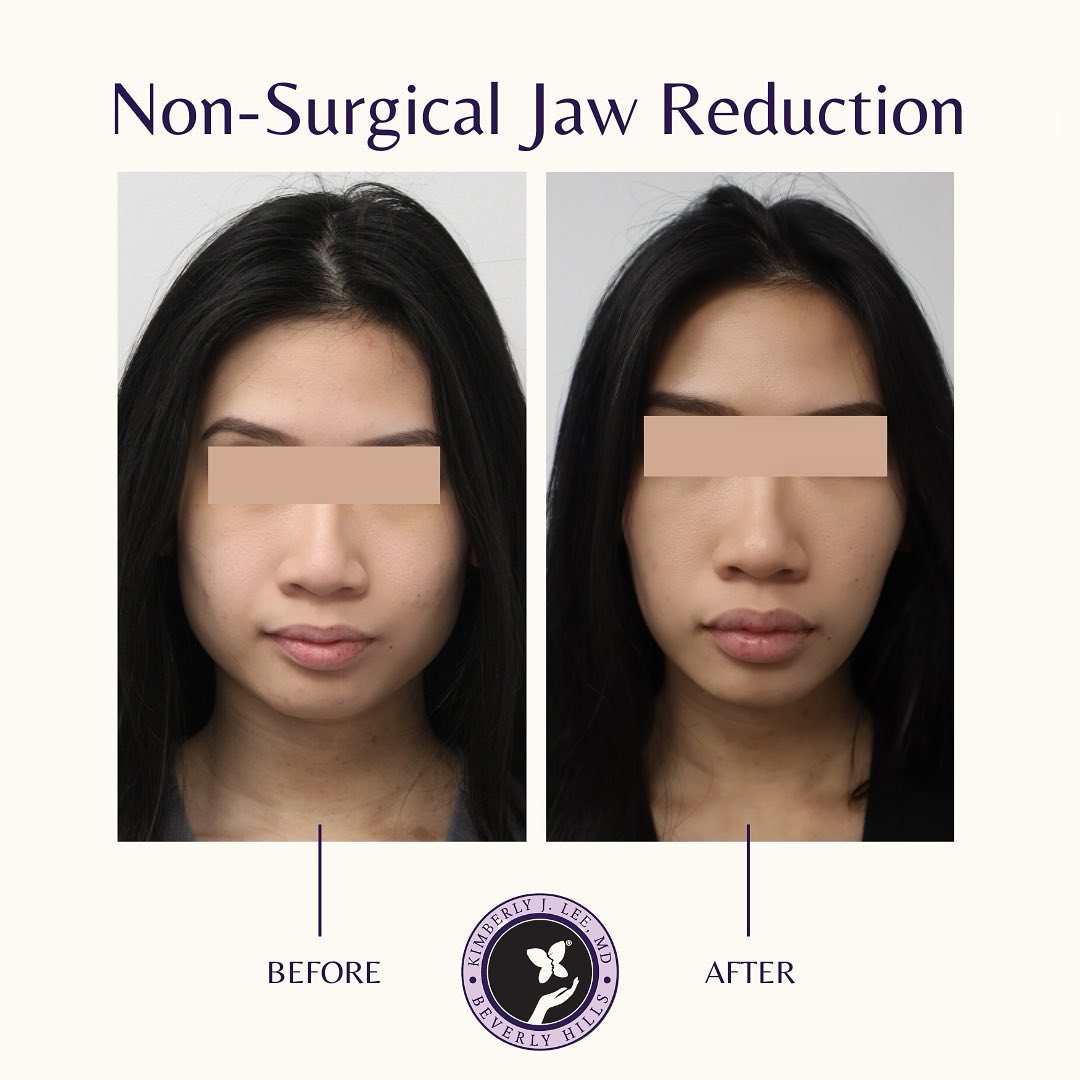 Jaw Contouring Before & After Photos | Dr. Kimberly Lee