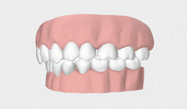 Overjet Antes E Depois