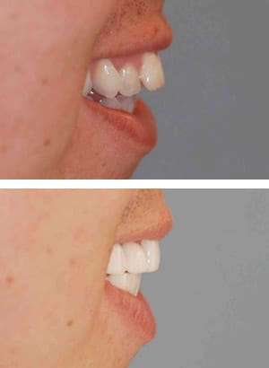 Underbite and Overbite Correction Without Surgery