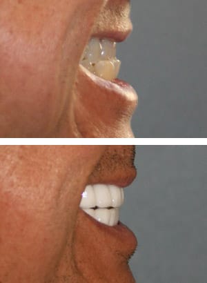 Celebrities With Underbites