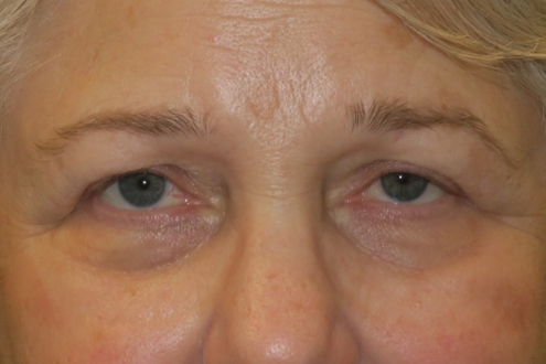 Ptosis Repair Before & After Photos | Nava Face & Eye