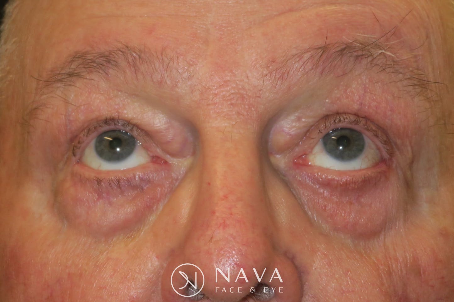 Mohs Reconstruction Before And After Photos Nava Face And Eye