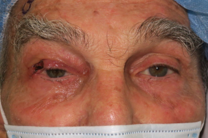 Mohs Reconstruction Before & After Photos | Nava Face & Eye