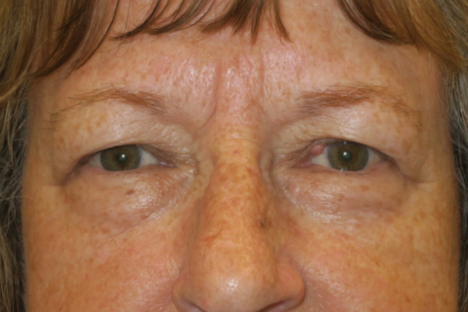 Mohs Reconstruction Before & After Photos | Nava Face & Eye