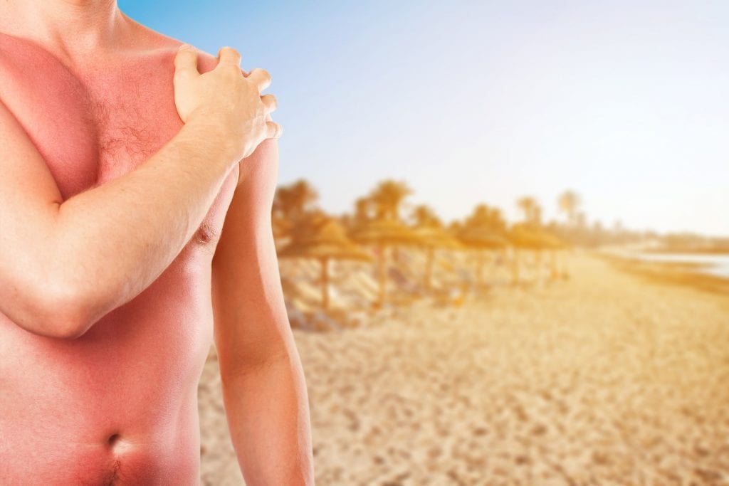 How to Treat an Accidental Sunburn (and Prevent It Next Time)