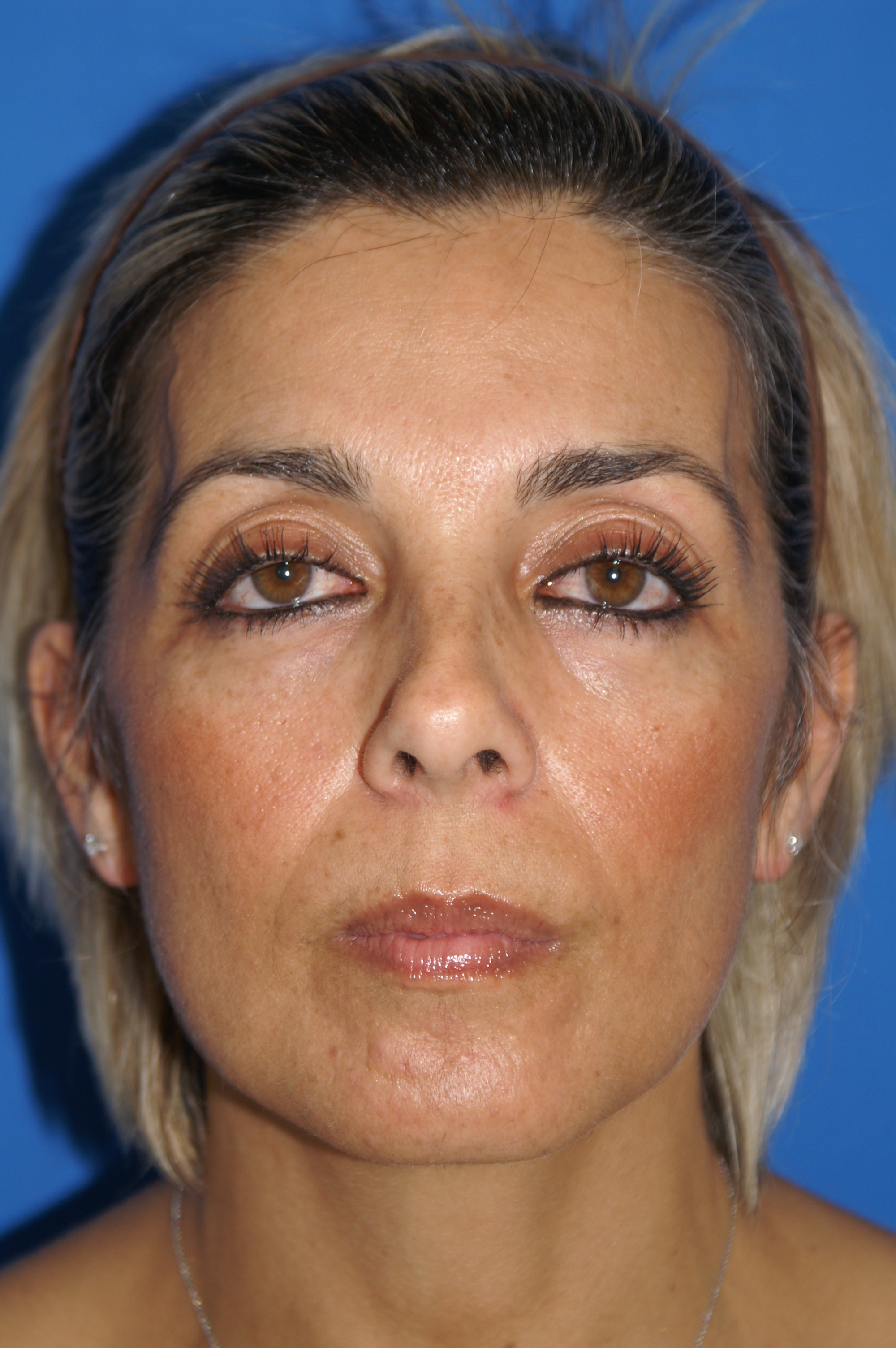 Patient 116252672 | Brow Lift Before & After Photos | Shuster Plastic ...