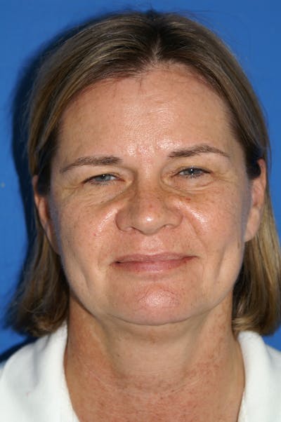 Facelift Before & After Photos | Shuster Plastic Surgery