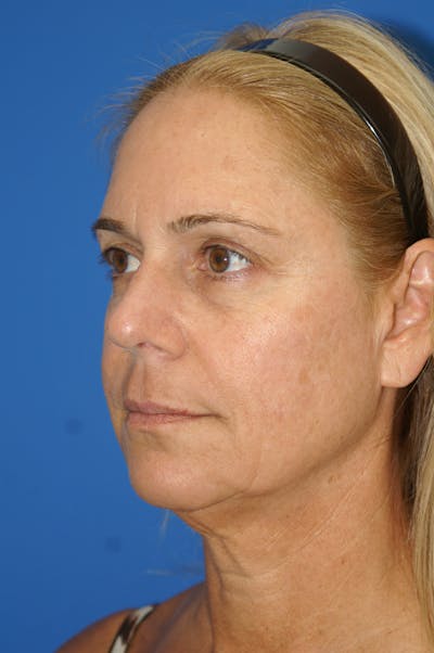 Facelift Before & After Photos | Shuster Plastic Surgery