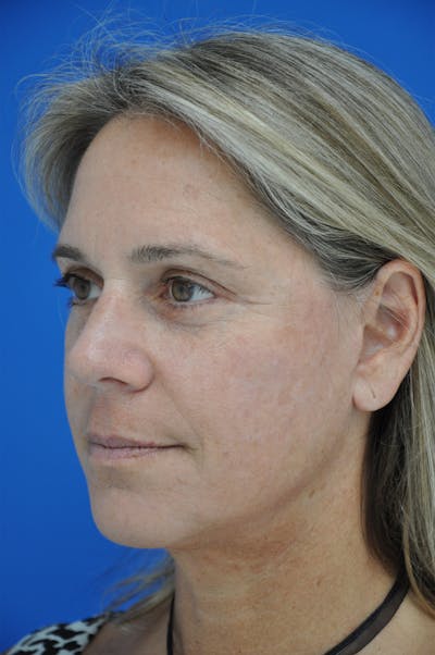 Facelift Before & After Photos | Shuster Plastic Surgery