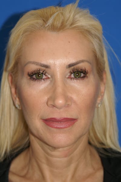 Facelift Before & After Photos | Shuster Plastic Surgery