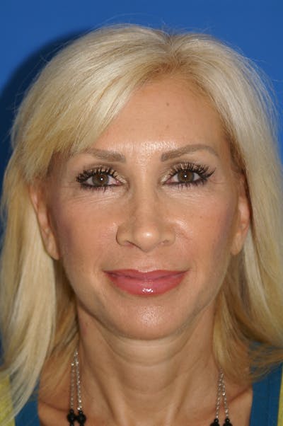 Facelift Before & After Photos | Shuster Plastic Surgery
