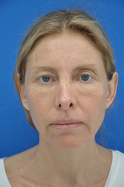 Facelift Before & After Photos | Shuster Plastic Surgery