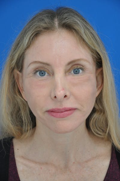 Facelift Before & After Photos | Shuster Plastic Surgery