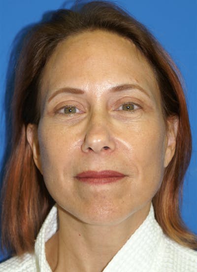 Facelift Before & After Photos | Shuster Plastic Surgery