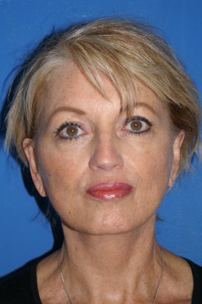 Facelift Before & After Photos | Shuster Plastic Surgery
