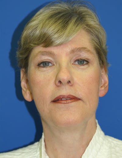 Facelift Before & After Photos | Shuster Plastic Surgery