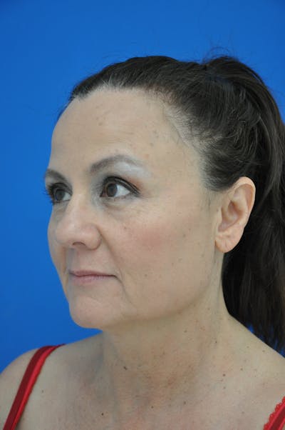 Facelift Before & After Photos | Shuster Plastic Surgery