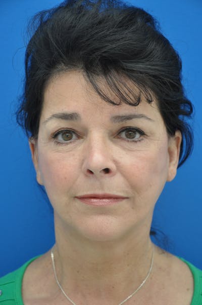 Facelift Before & After Photos | Shuster Plastic Surgery