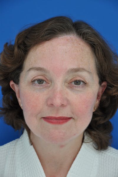 Facelift Before & After Photos | Shuster Plastic Surgery