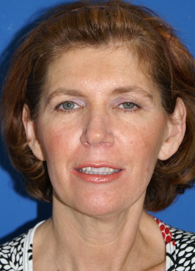 Facelift Before & After Photos | Shuster Plastic Surgery