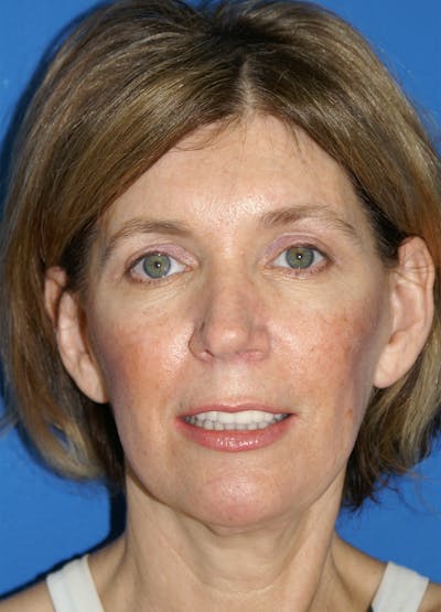 Facelift Before & After Photos | Shuster Plastic Surgery