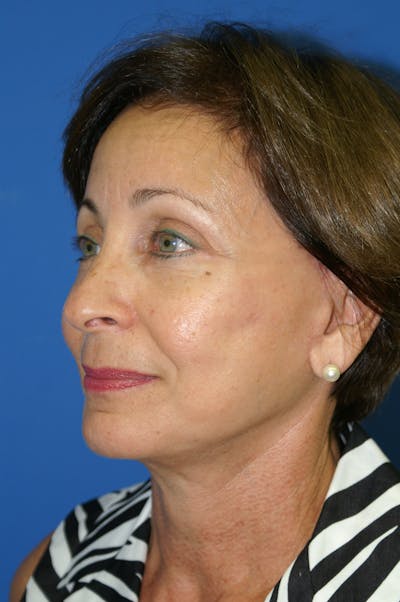 Facelift Before & After Photos | Shuster Plastic Surgery