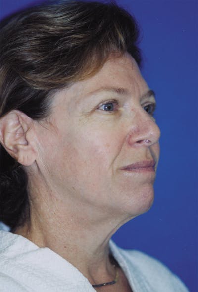 Facelift Before & After Photos | Shuster Plastic Surgery