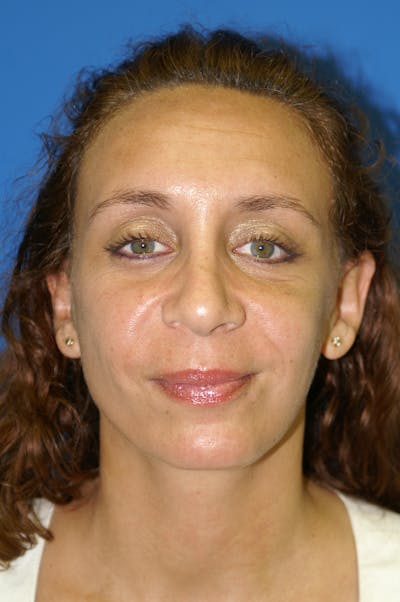 Facelift Before & After Photos | Shuster Plastic Surgery