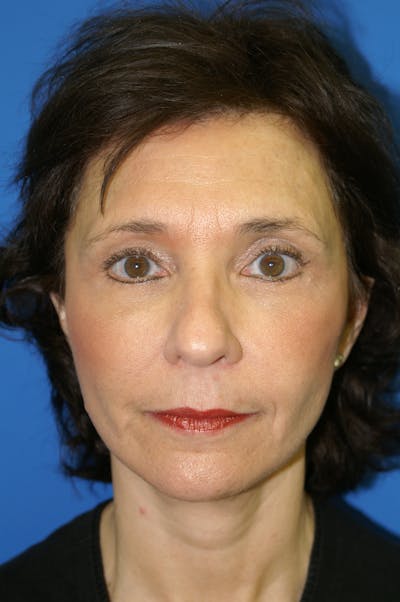 Facelift Before & After Photos | Shuster Plastic Surgery