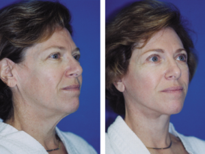 Facial Profile Optimization | Bernard A. Shuster, MD, FACS
