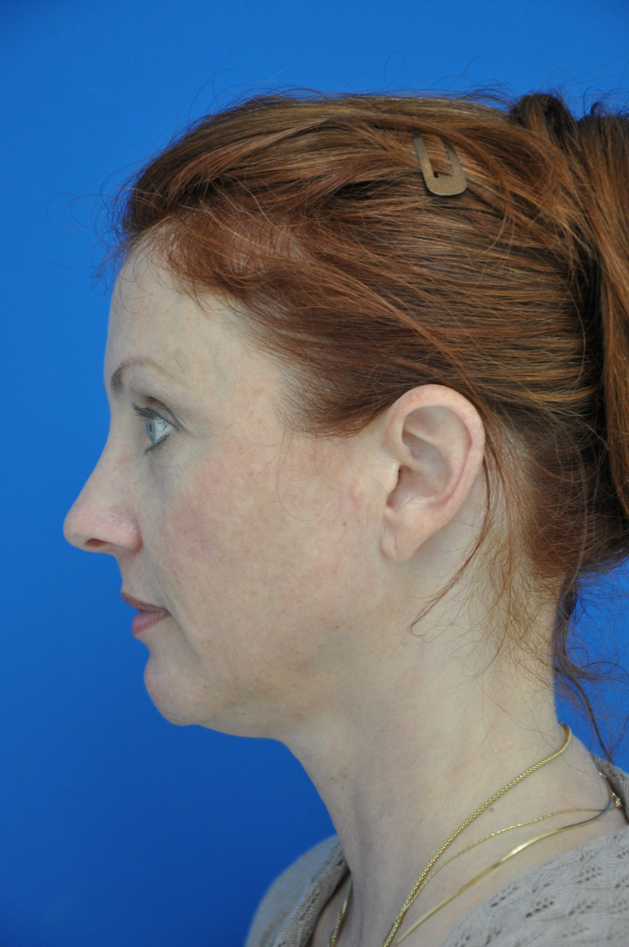 Patient 148756398 | Facelift Before & After Photos | Shuster Plastic ...