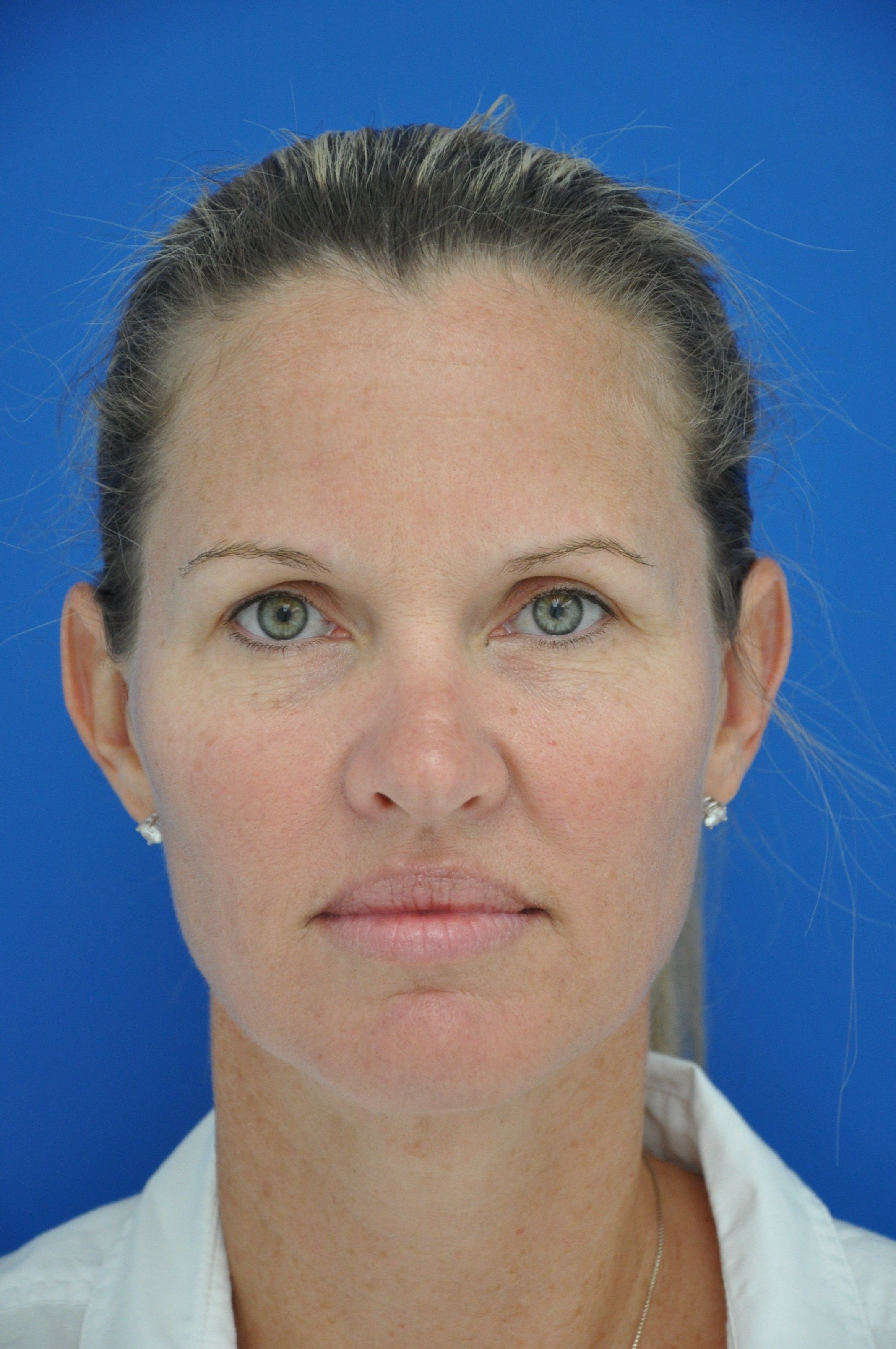 Patient 148756411 | Facelift Before & After Photos | Shuster Plastic ...
