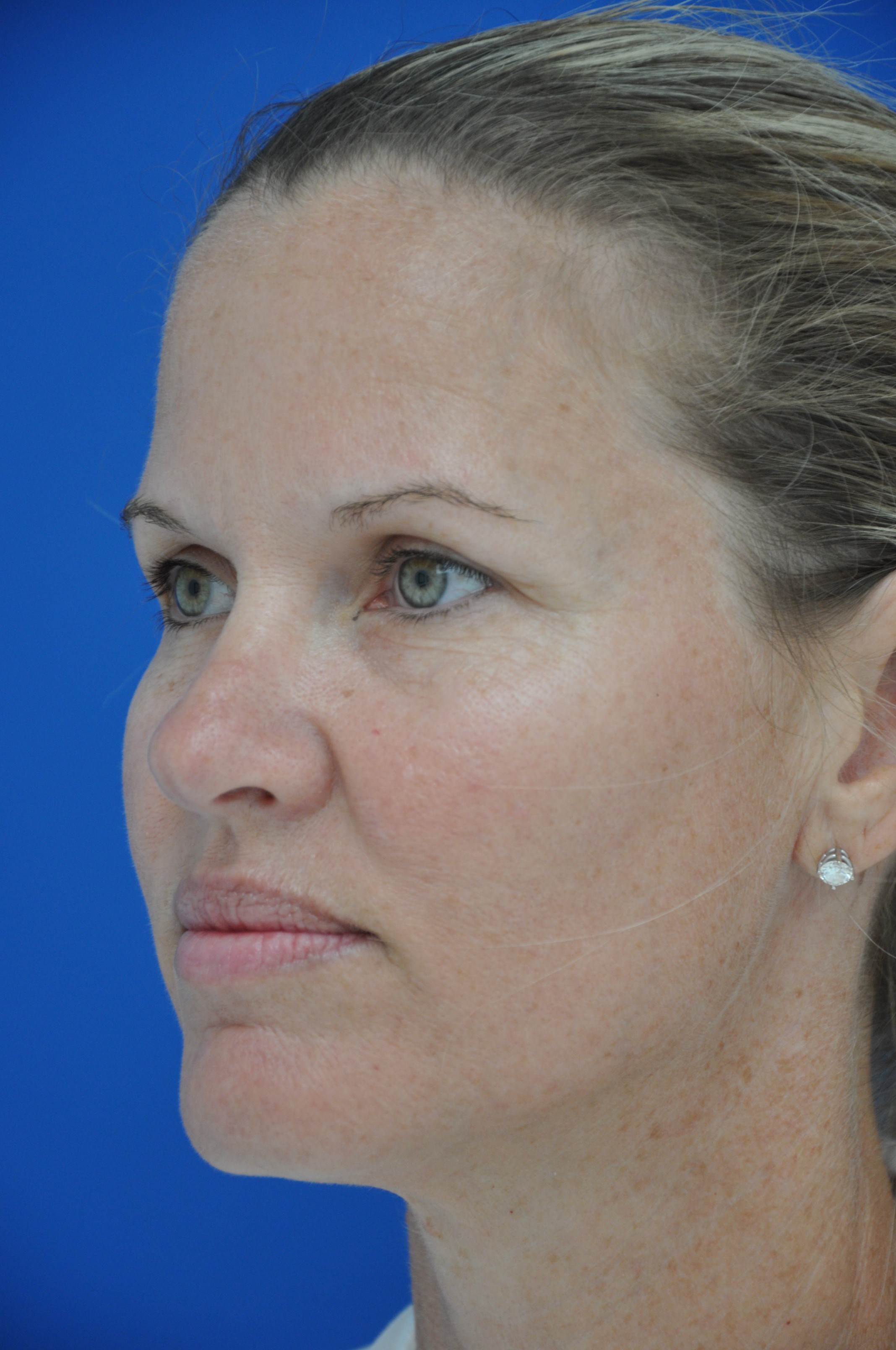 Patient 148756411 | Facelift Before & After Photos | Shuster Plastic ...
