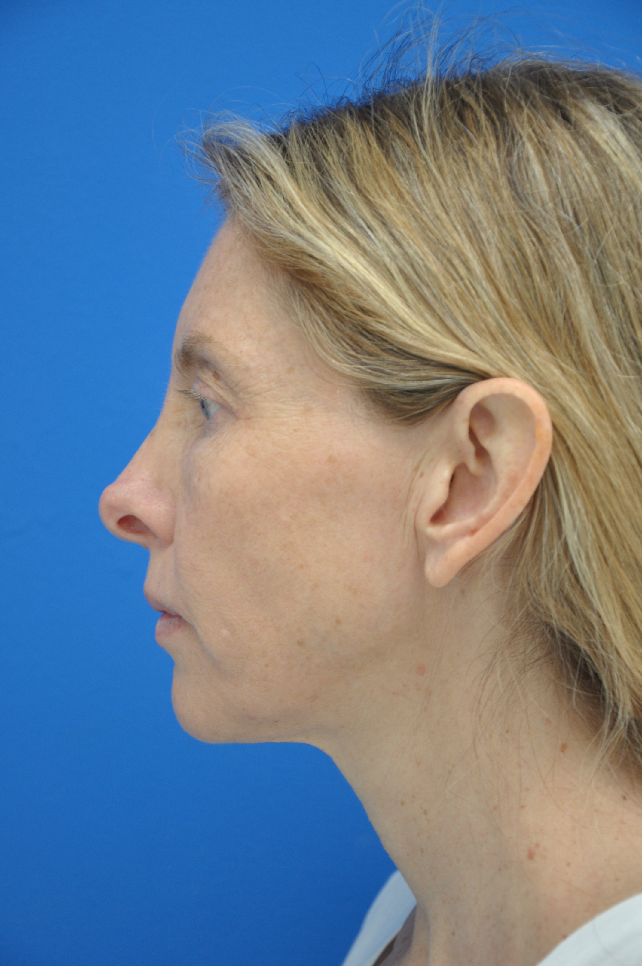 Patient 148756992 | Facelift Before & After Photos | Shuster Plastic ...