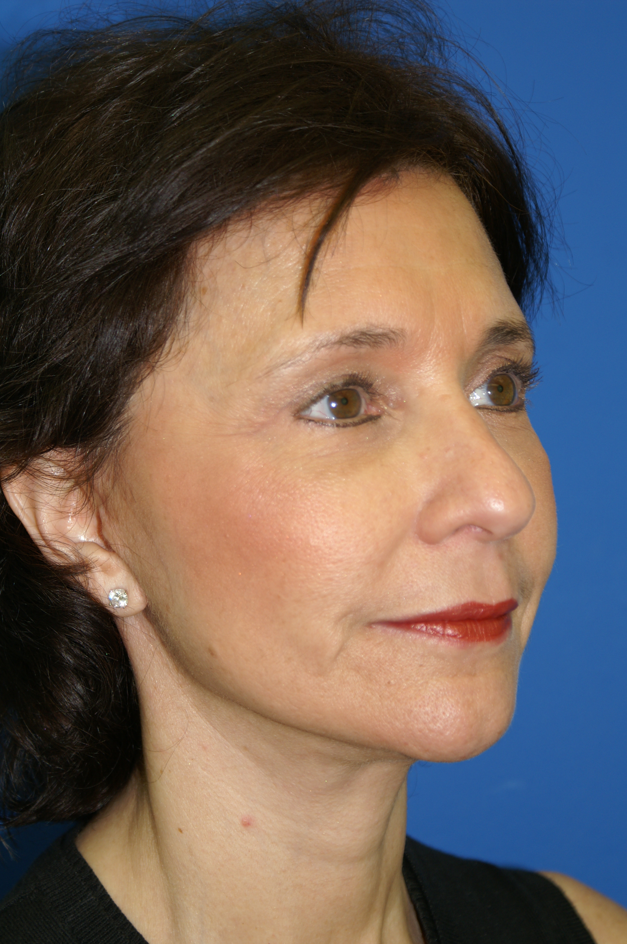 Patient 148757048 | Facelift Before & After Photos | Shuster Plastic ...