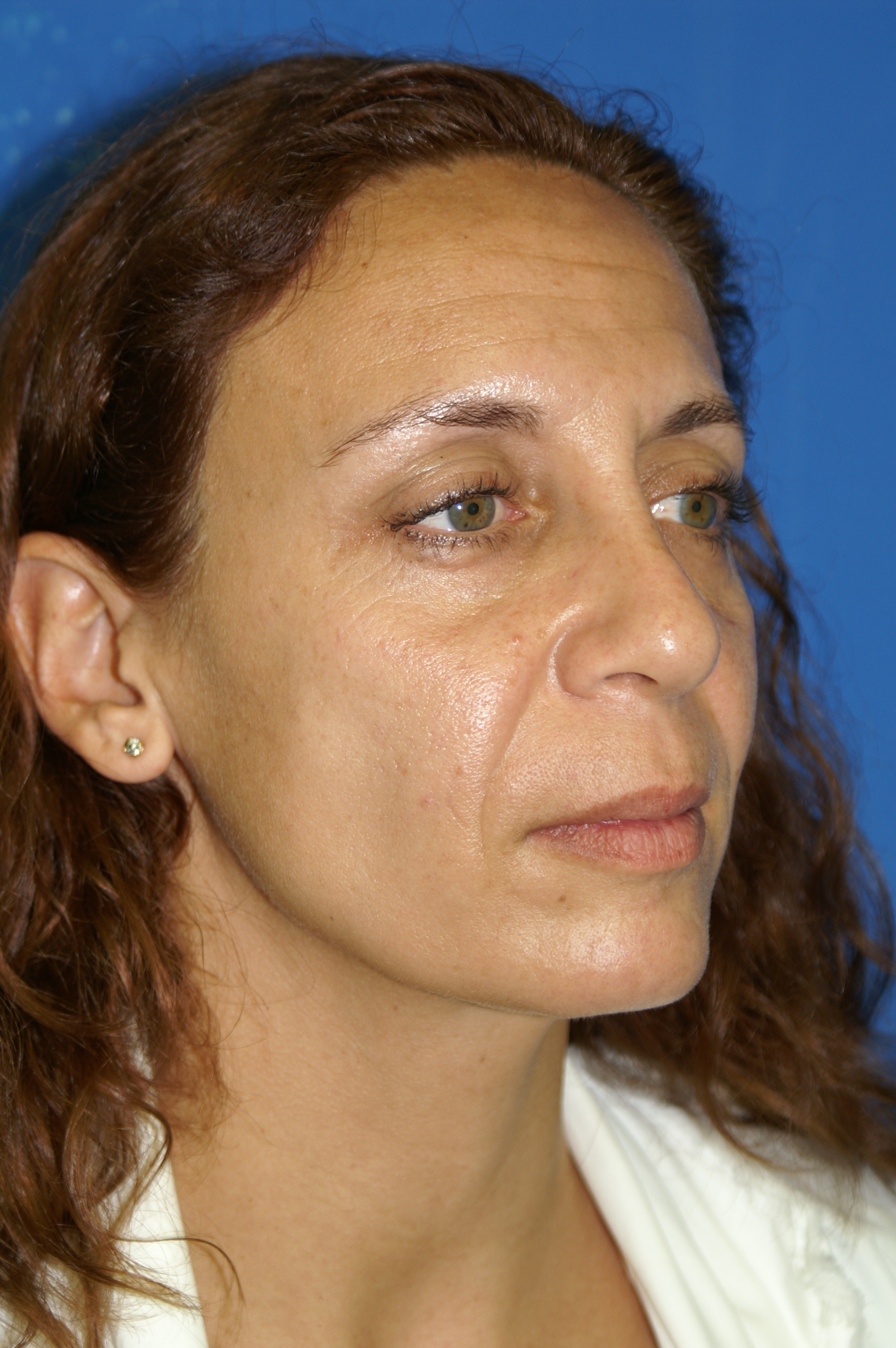 Patient 148757086 | Facelift Before & After Photos | Shuster Plastic ...