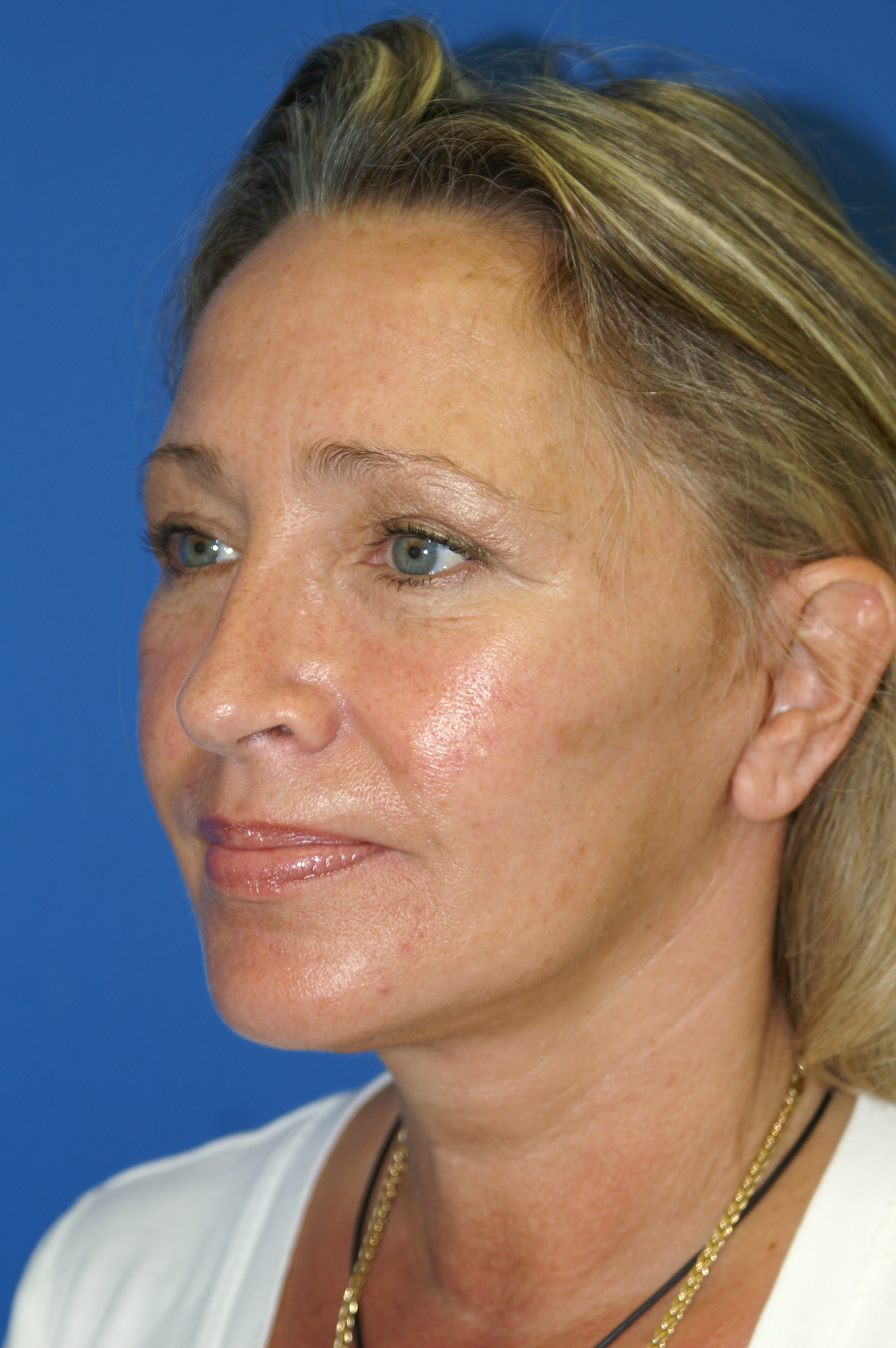 Patient 148757552 | Facelift Before & After Photos | Shuster Plastic ...