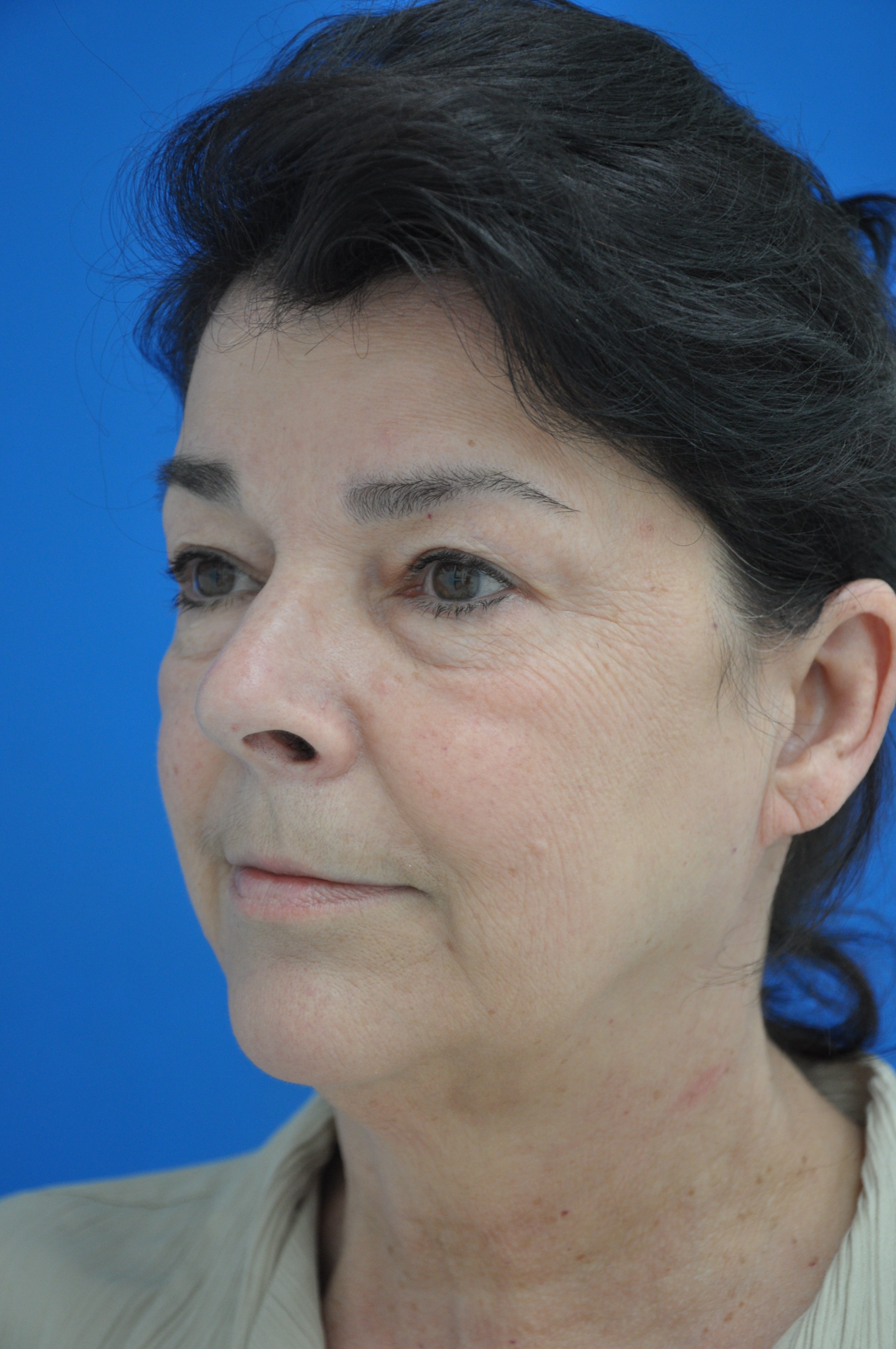 Patient 148757554 | Facelift Before & After Photos | Shuster Plastic ...