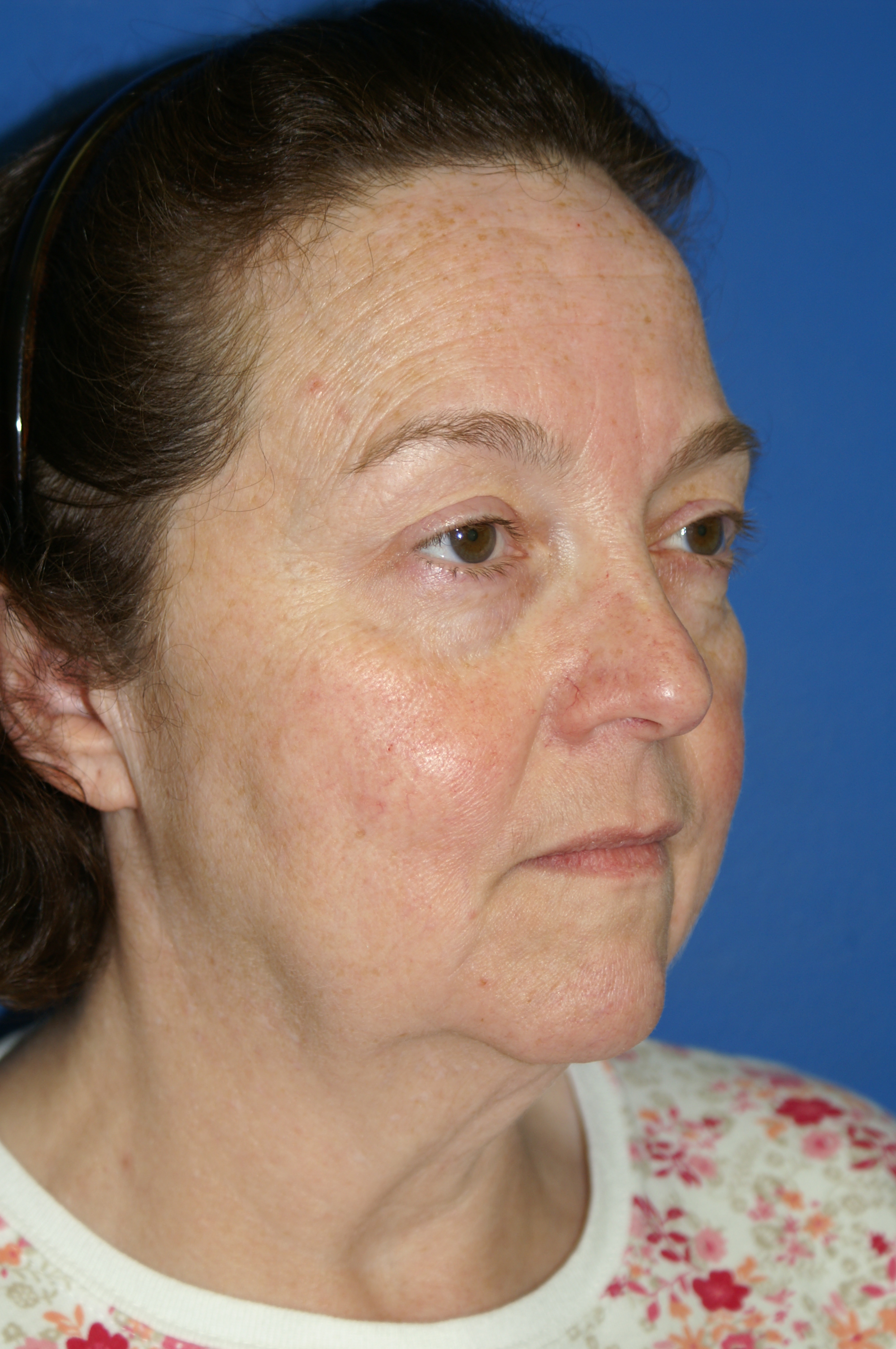 Patient 148757667 | Facelift Before & After Photos | Shuster Plastic ...
