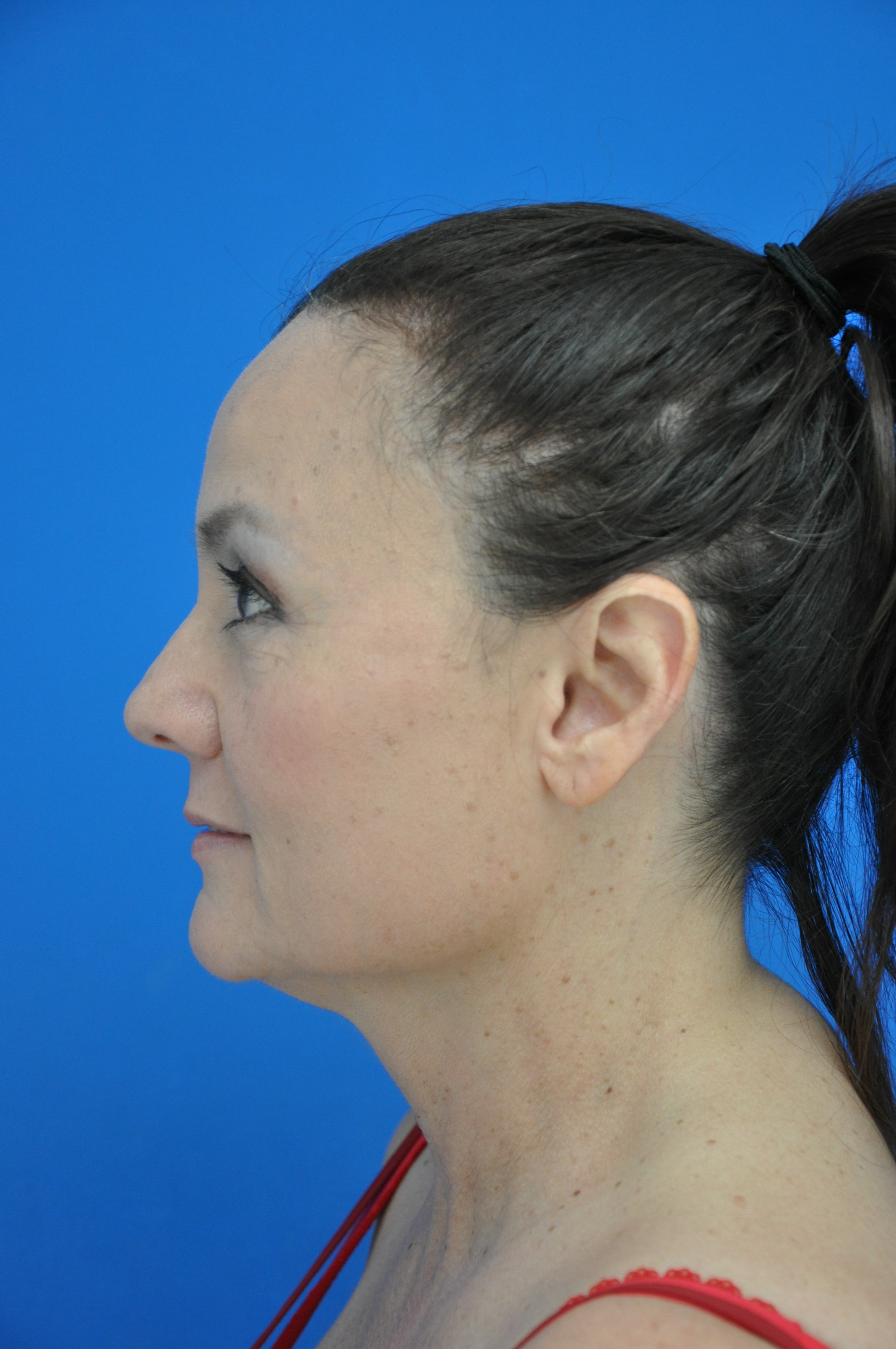 Patient 148757669 | Facelift Before & After Photos | Shuster Plastic ...