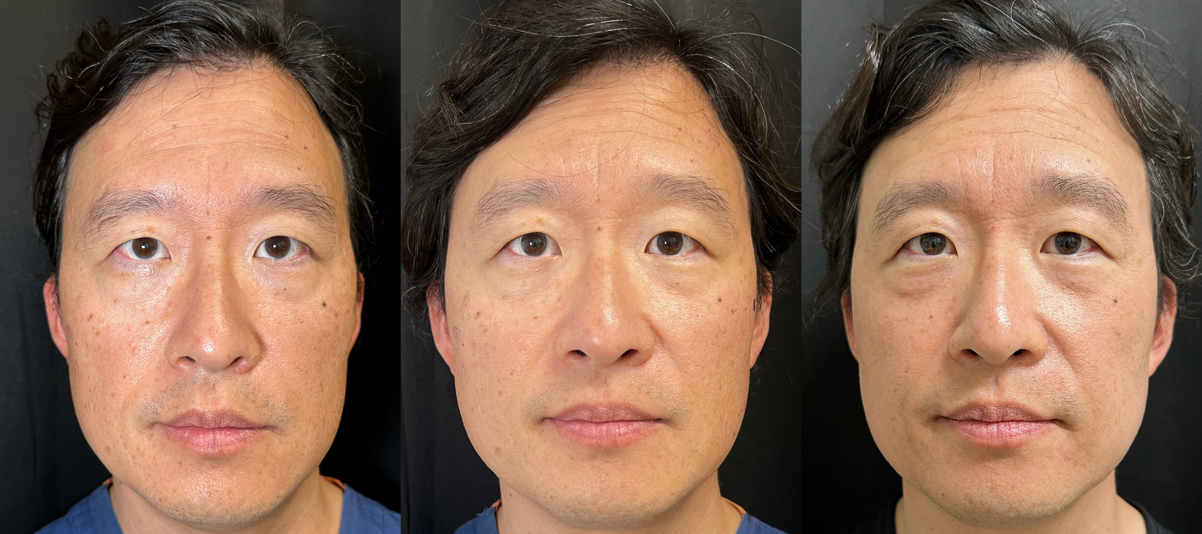 Patient 356511 | BBL/Moxi Before & After Photos | Richard H. Lee