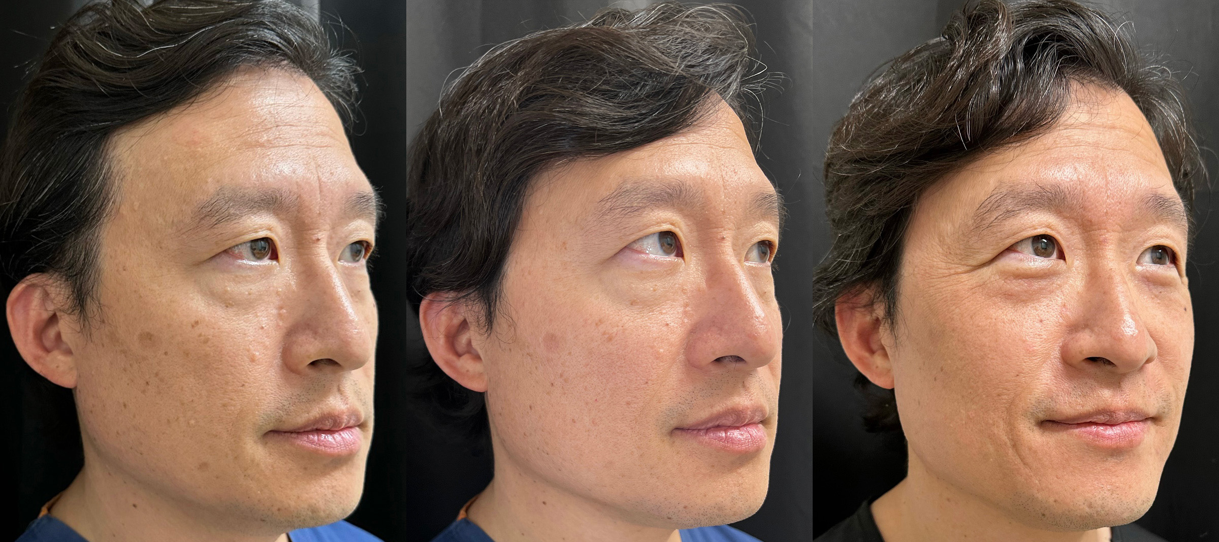 Patient 356511 | BBL/Moxi Before & After Photos | Richard H. Lee