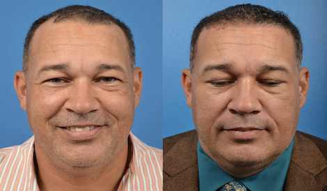 Male Pattern Baldness: Your Options to Fight Thinning Hair