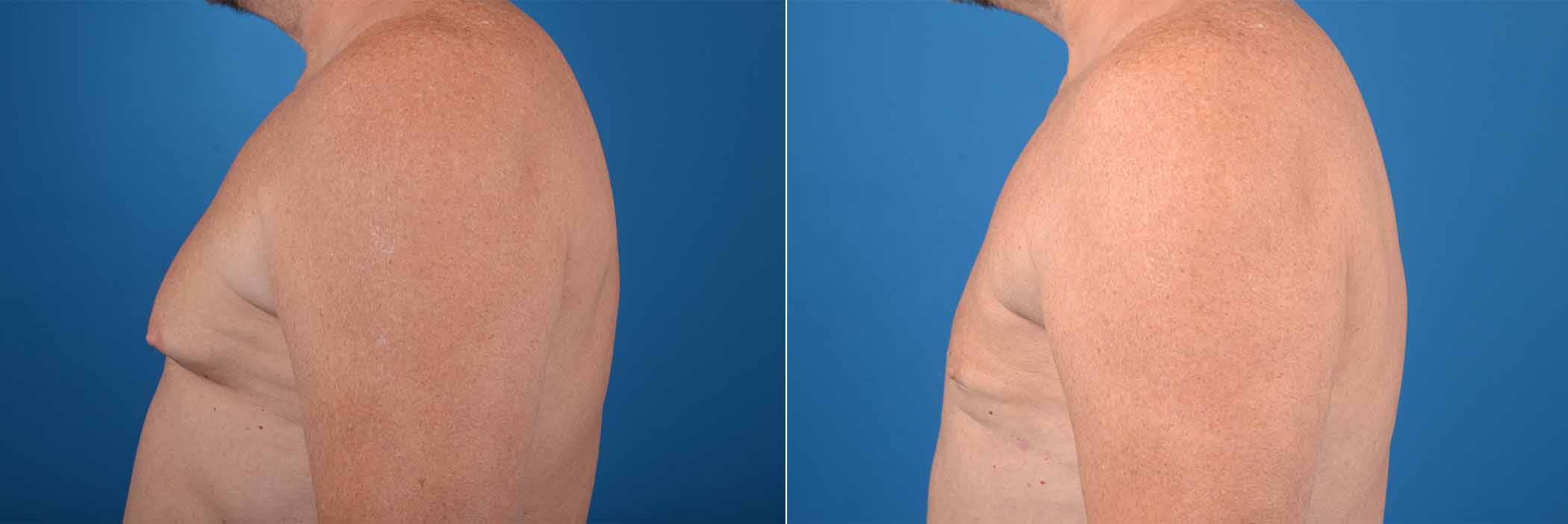 Patient 940682 Male Breast Reduction Gynecomastia Before And After