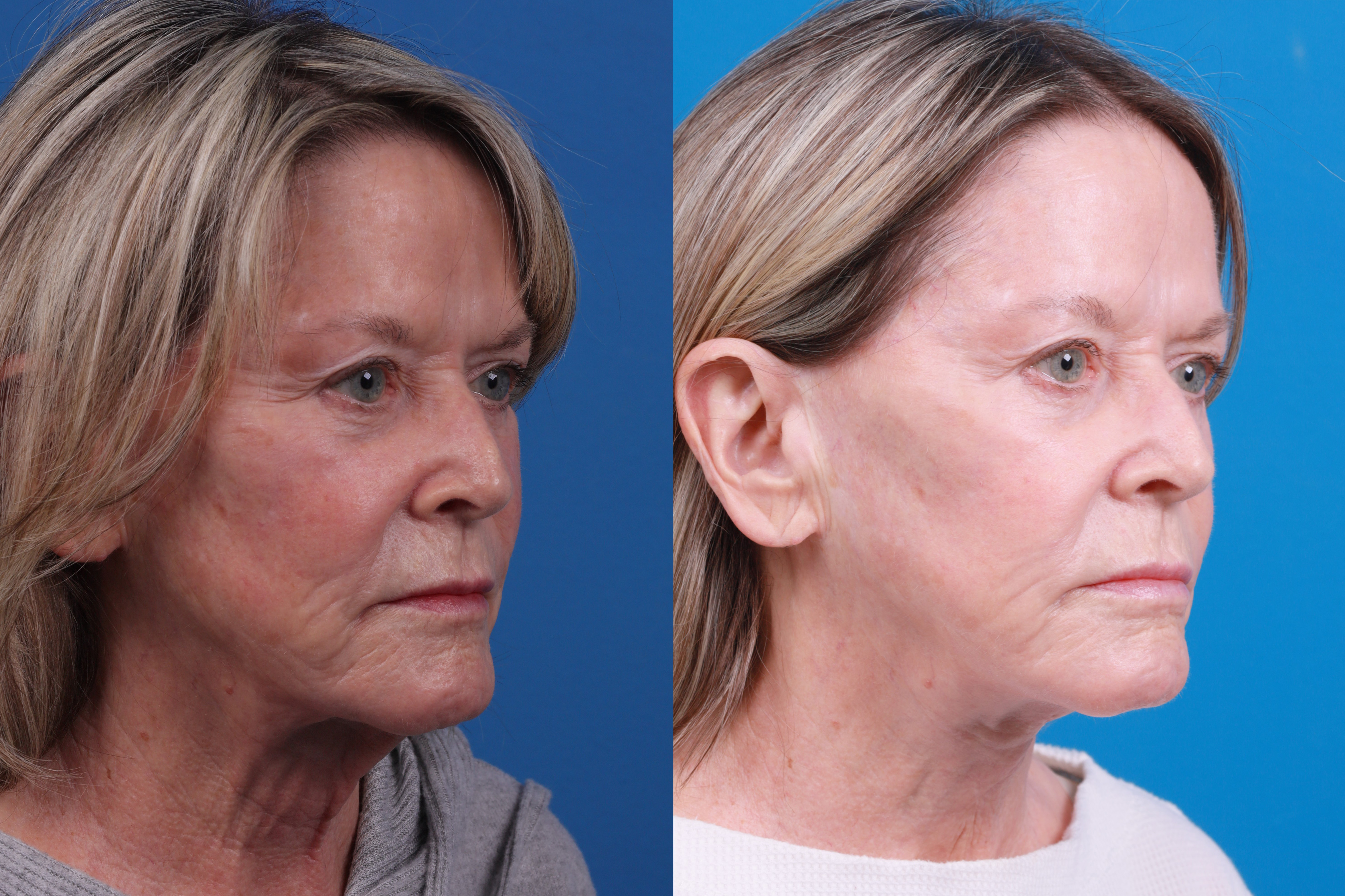 Patient 146900704 | Profile Neck Lift Before & After Photos | Clevens ...